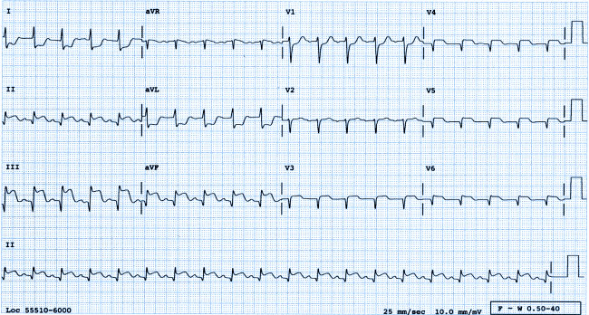 Inferior wall and right ventricular infarct - ECG