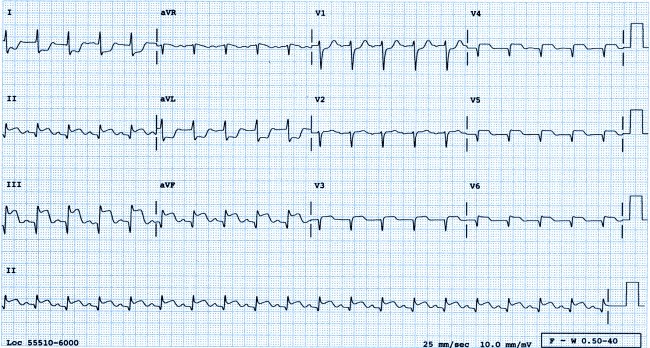 Inferior wall and right ventricular infarct - ECG ~ Medicine Hack