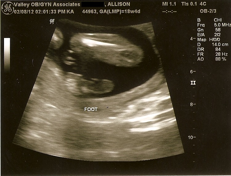 A Little Blueberry: 18 Weeks and an Ultrasound!