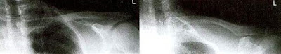 Estudo Radiográfico : ROTINA DE CLAVÍCULA