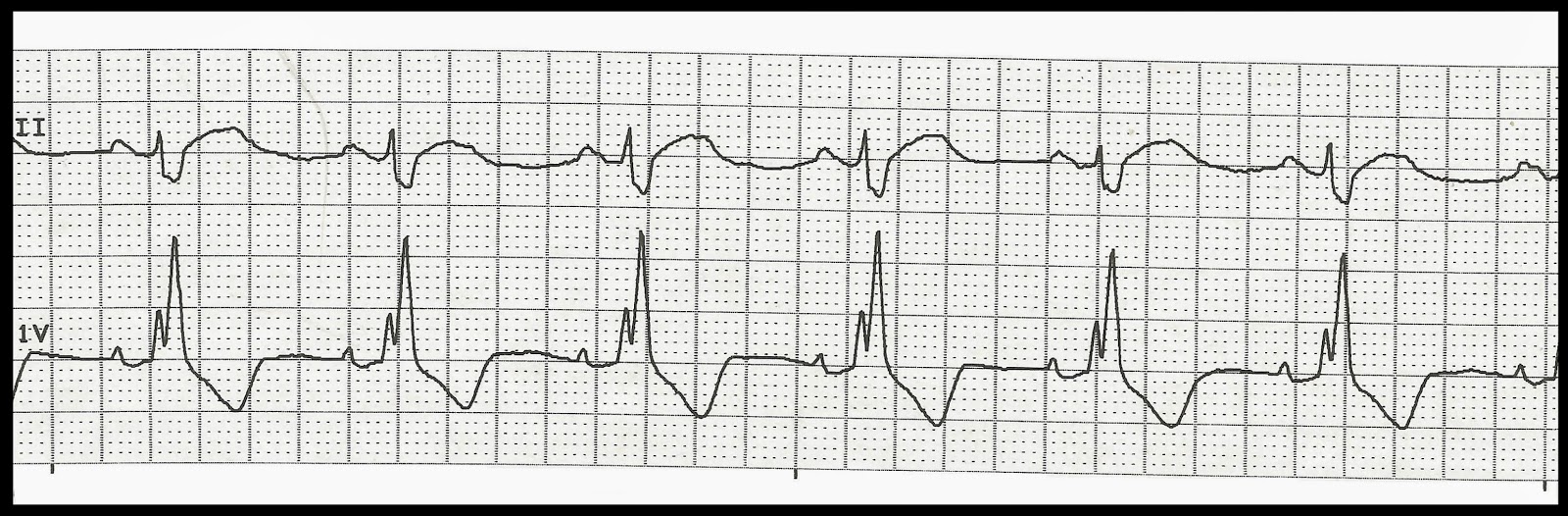 Practice EKG Strips 420