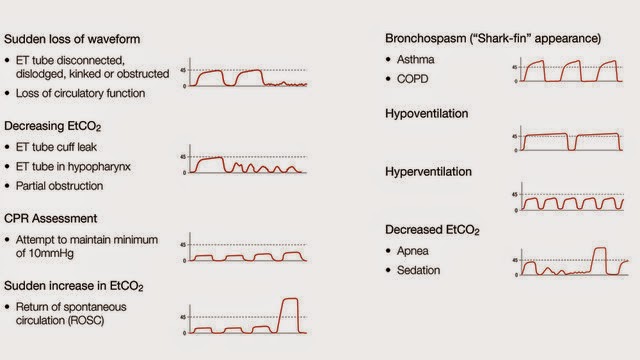 Adult Emergency Medicine: Asthma - Pathophysiology and Clinical Signs