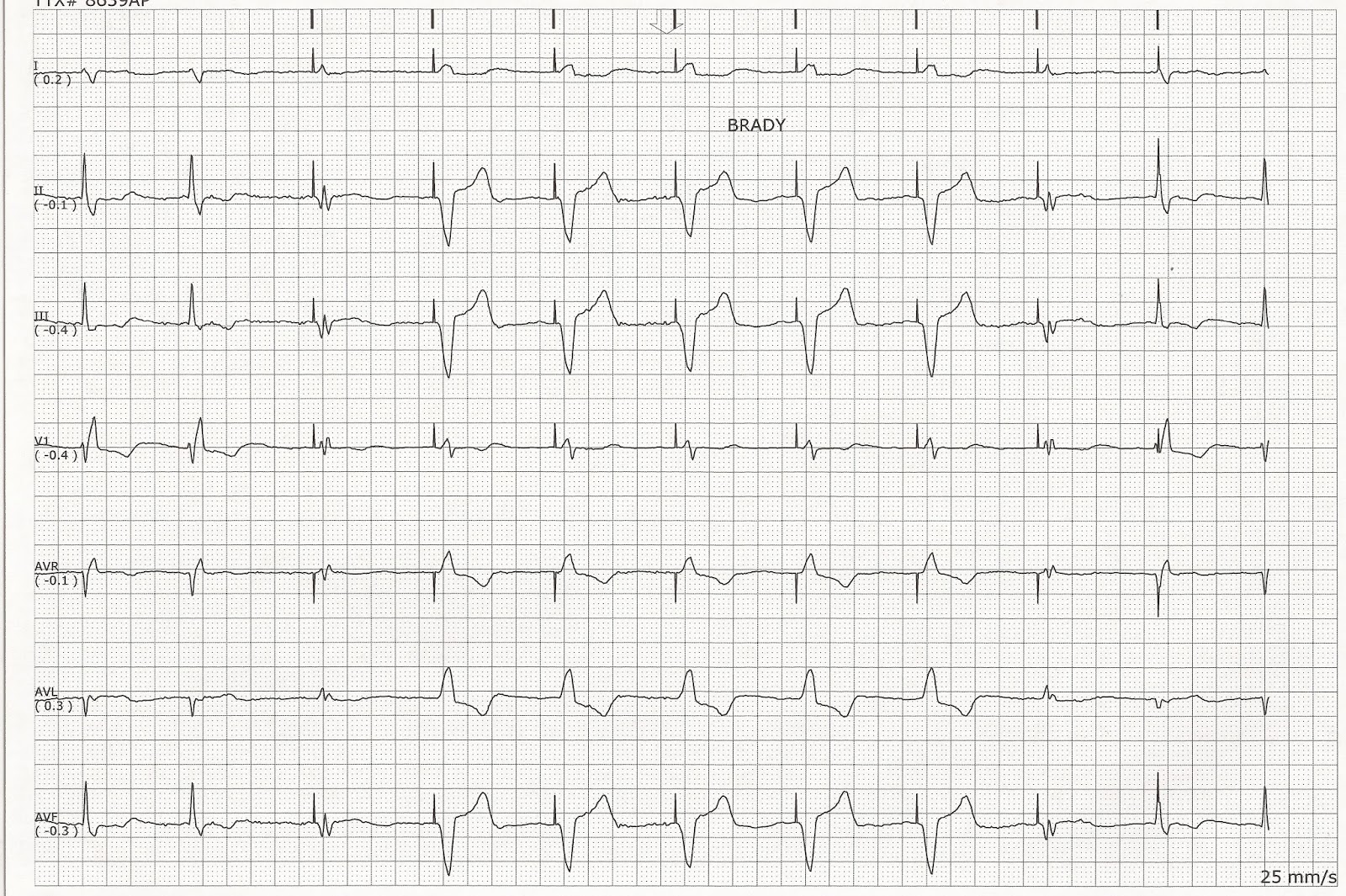 Float Nurse: Ventricular paced with some fusion complexes