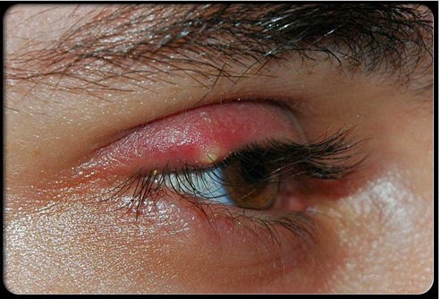 Understanding about eye infection-Stye