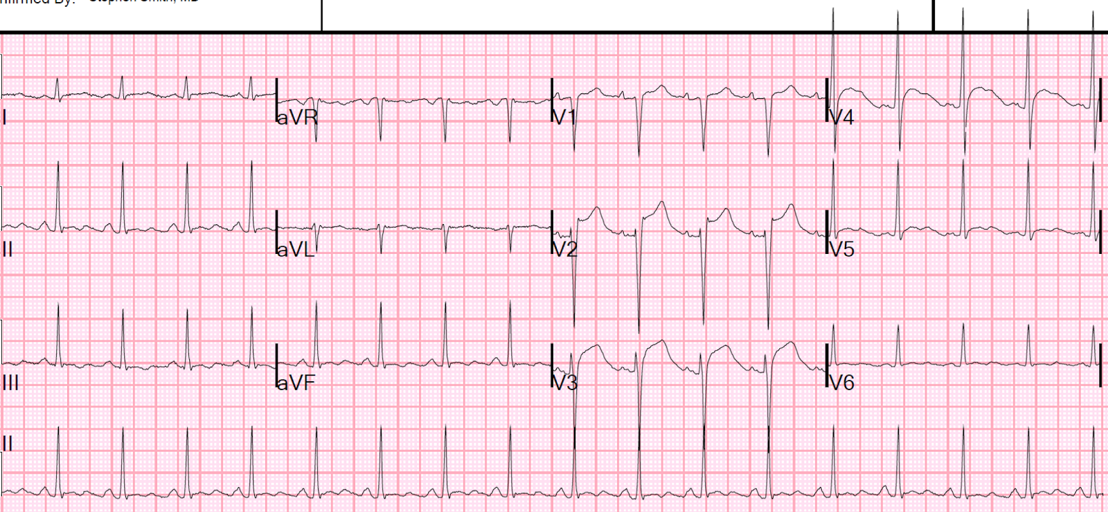 Dr. Smith's ECG Blog: Is this Saddleback a STEMI??