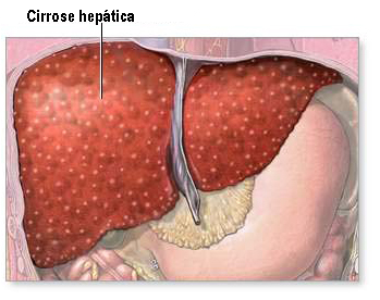 Doenças Sistema Digestório: Cirrose Hepatica