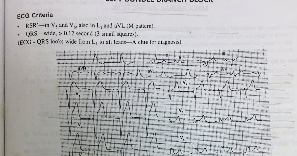 E.C.G OF LBBB AND ECG OF MYOCARDIAL INFARCTION