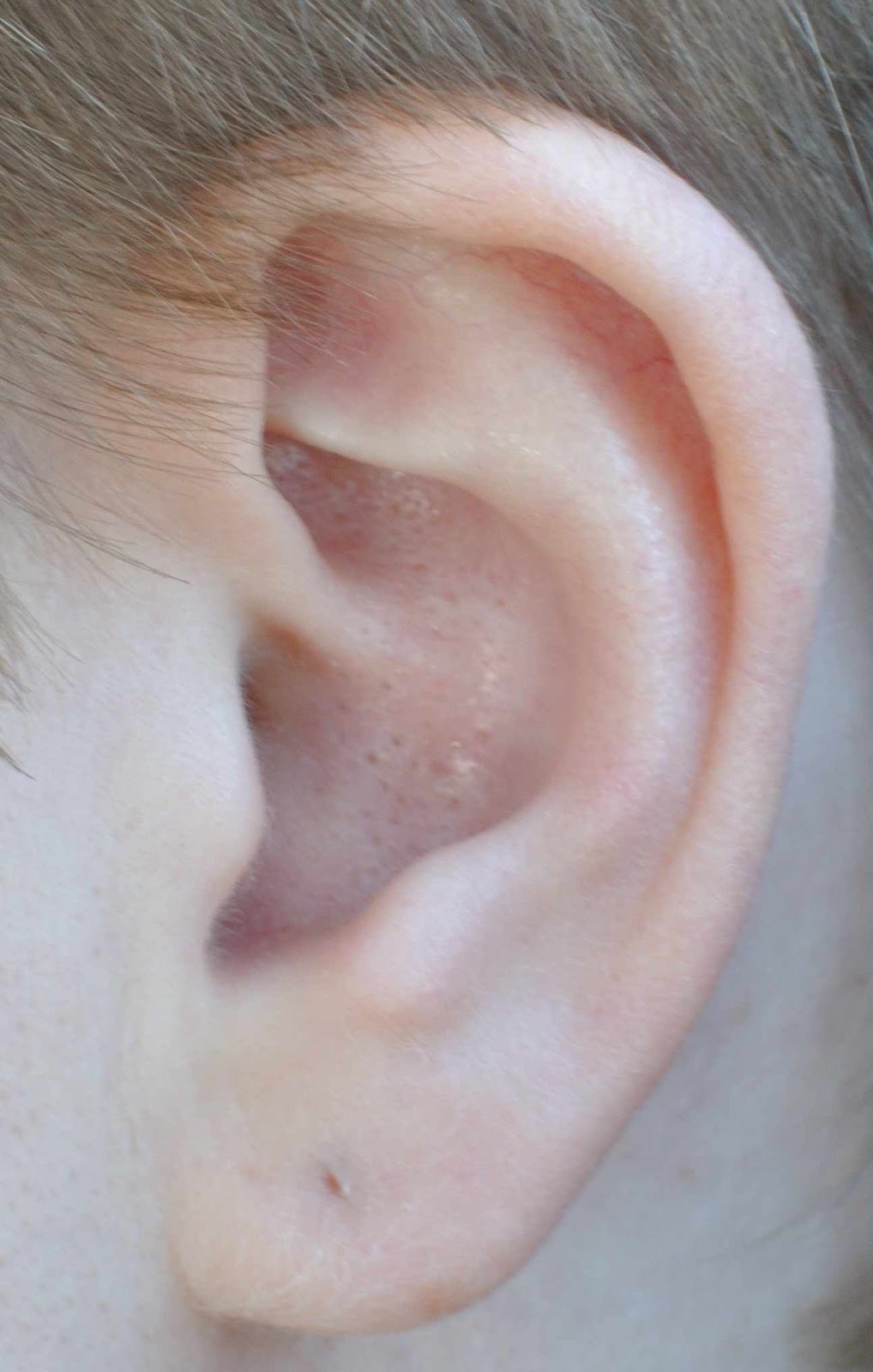 Things that make me go aagghh!: Getting rid of argyria (silver staining ...