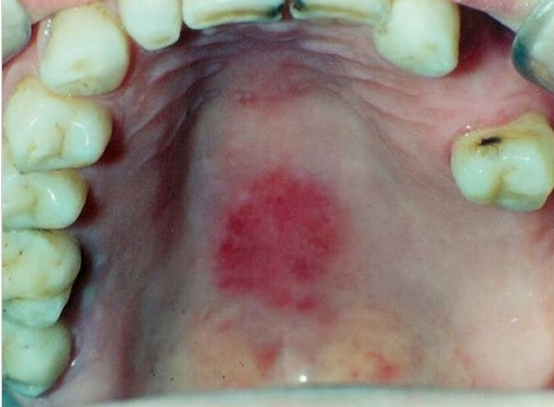 bir diş hekiminin günlüğü: Median rhomboid glossitis