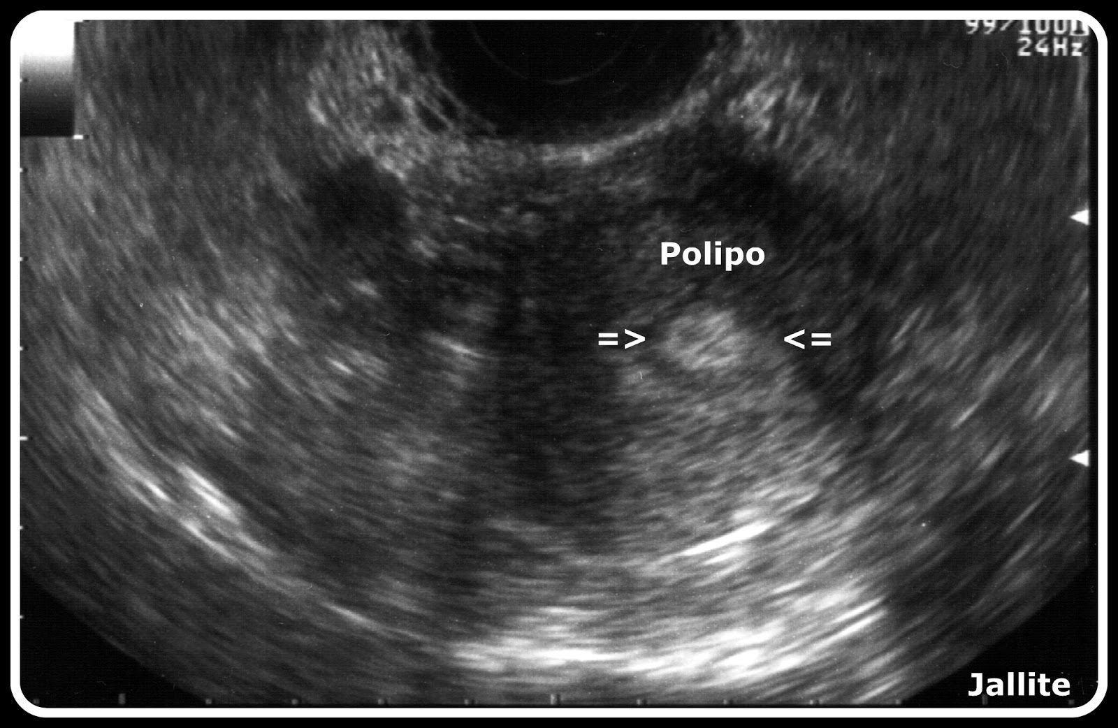 Pólipo Endometrial