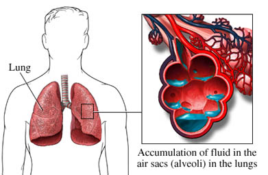 ENFERMERÍA CARDIOVASCULAR: ¿La contaminación afecta al corazón?