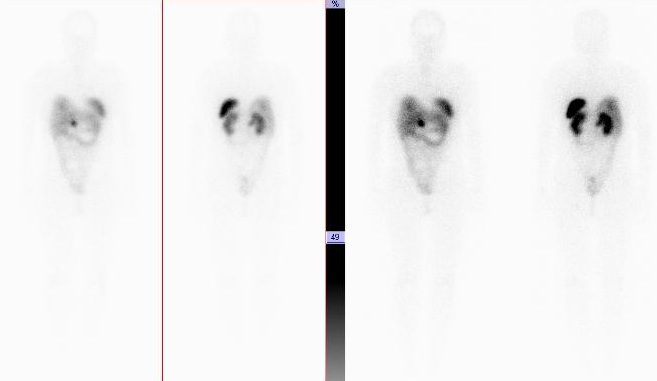 NuCleaR MuNkeE: In-111 Pentetreotide Imaging