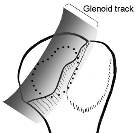 CORACOIDES: Glenoid Track