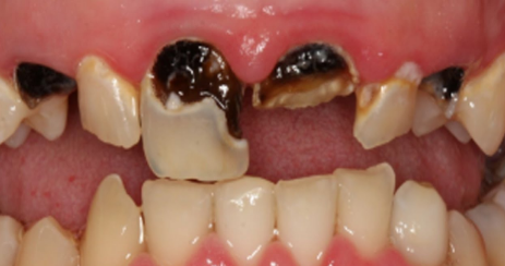 DINESH'S DENTAL PARADISE: Sugar and dental caries