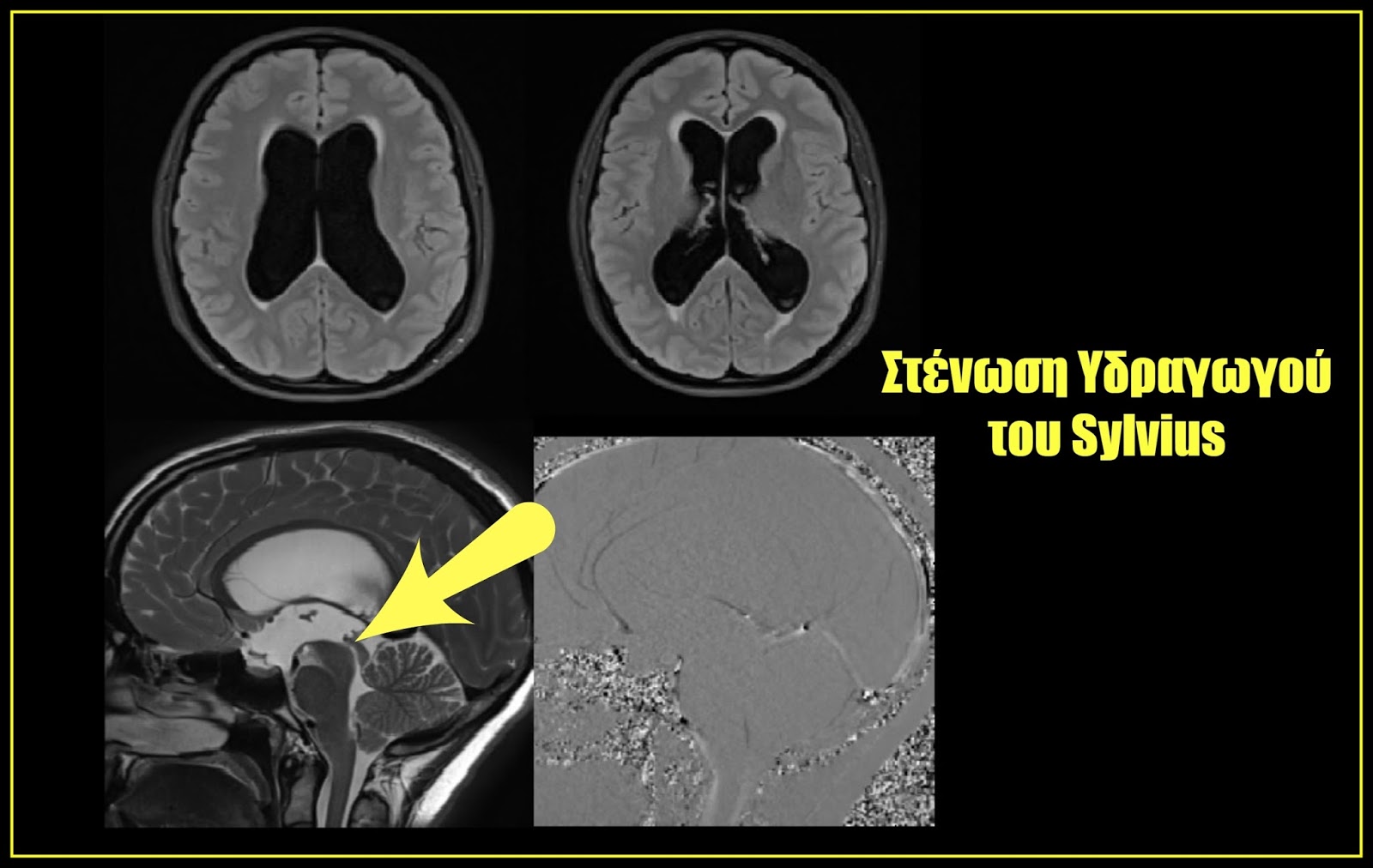 Κωνσταντίνος Χ. Δαβανέλος: Στένωση του υδραγωγού του Sylvius.