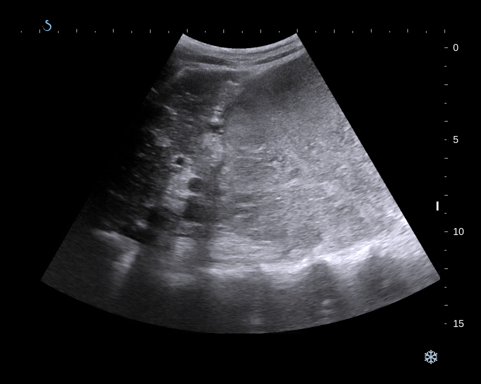 VIETNAMESE MEDIC ULTRASOUND: CASE 390: PEDUNCULATED HCC, Dr PHAN THANH ...
