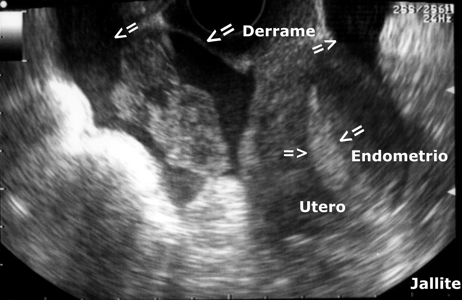 Enfermedad Inflamatoria Pelvica ( EIP)