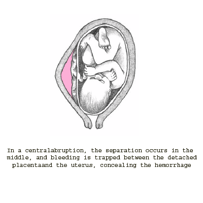 Lifenurses: Nursing Care Plans for Abruptio Placentae (Placenta Abruption)