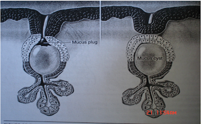 Healthy Ranula: Notes on Mucocele and Mucous Retention cyst-Etiology ...