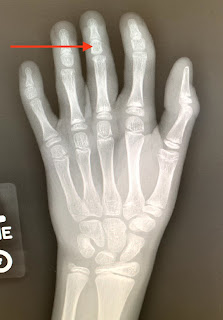 Symbrachydactyly- The typical form defined | Congenital Hand and Arm ...