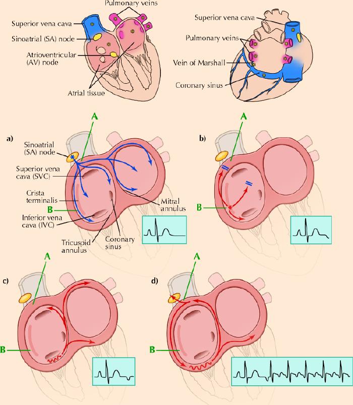 Dr Han Naung @ Henry Han : Electrophysiology and Heart Rhythm : The ...