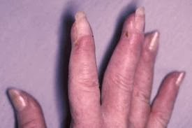 Medical Treatment Pictures-for Better Understanding: CREST Syndrome