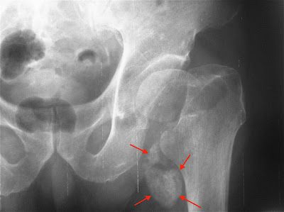 MedView Medical Imaging Consultancy Info Page: Calcific bursitis