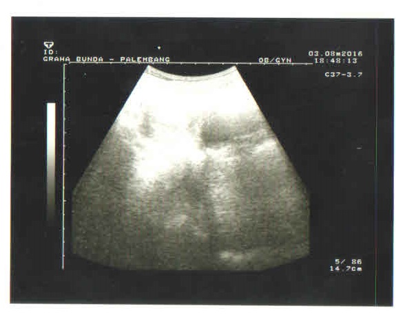 My Little Stories: Kehamilan Pertamaku Hanya Bertahan Tujuh Minggu