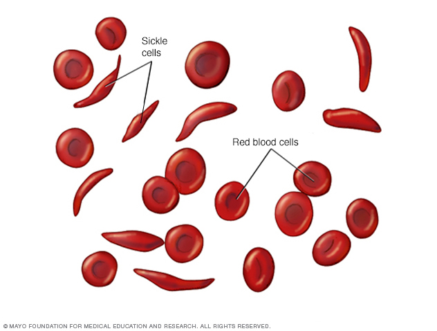 SICKLE CELL DISEASE