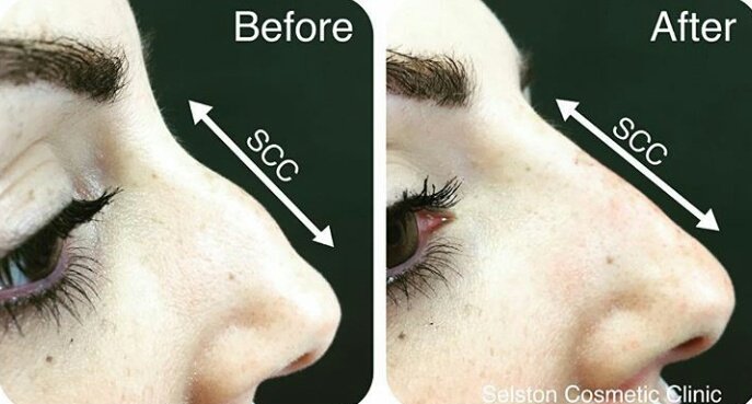 Selston Cosmetic Clinic: Transform Your Nose Shape with Non-Surgical ...