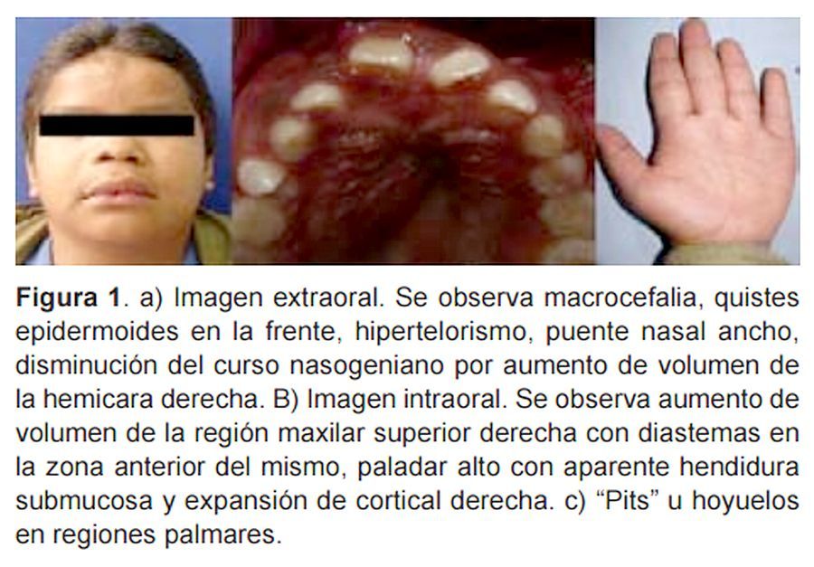 PDF: Síndrome de Gorlin-Goltz. Informe de un caso y revisión de la ...