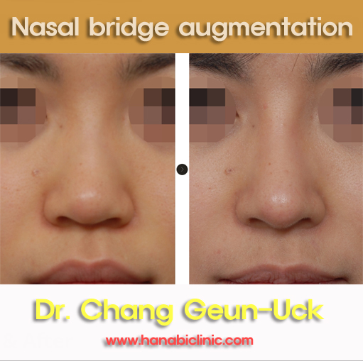 Best nose job clinic in Korea: Nasal bridge augmentation