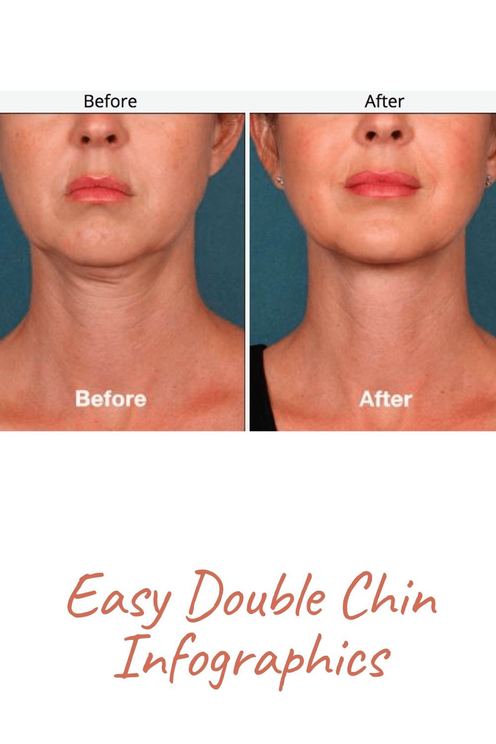 Easy Double Chin Infographics