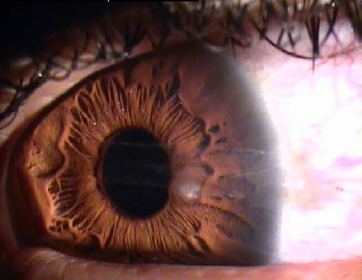 Wood Splinter In Eye