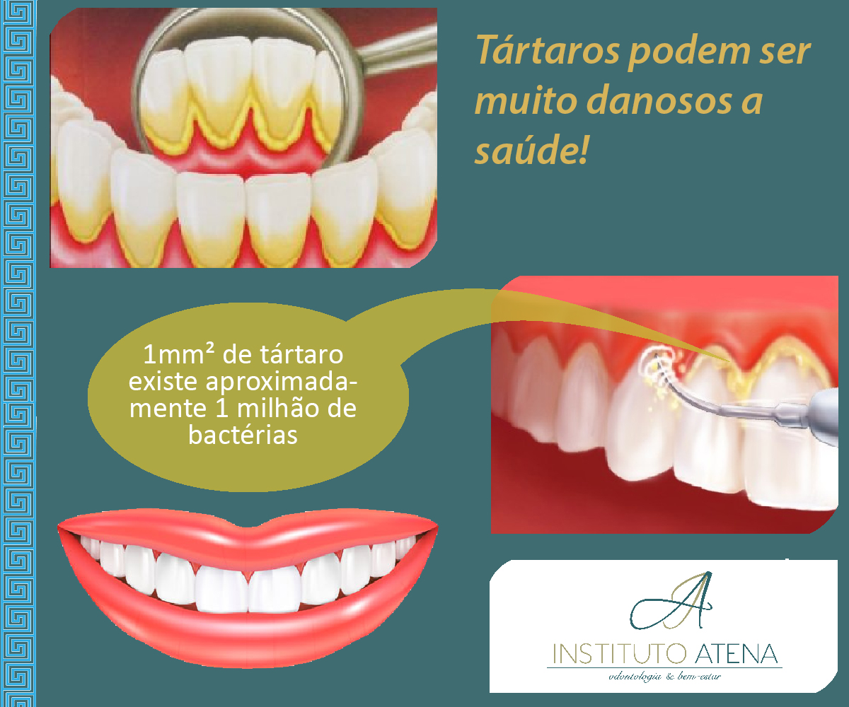 Instituto Atena - Odontologia e Bem Estar: Tártaros, saiba o que são e ...