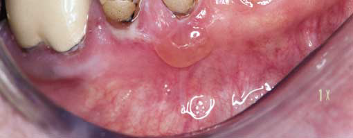 Healthy Ranula: Common Vesiculobullous Diseases Etiology,Clinical ...