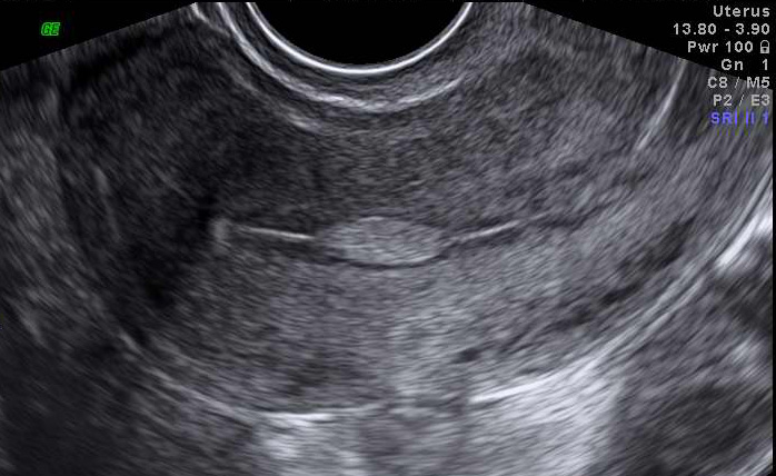 Luciana Chamié: Pólipos Endometriais