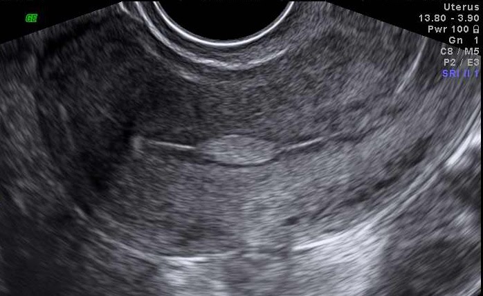 Luciana Chamié: Pólipos Endometriais