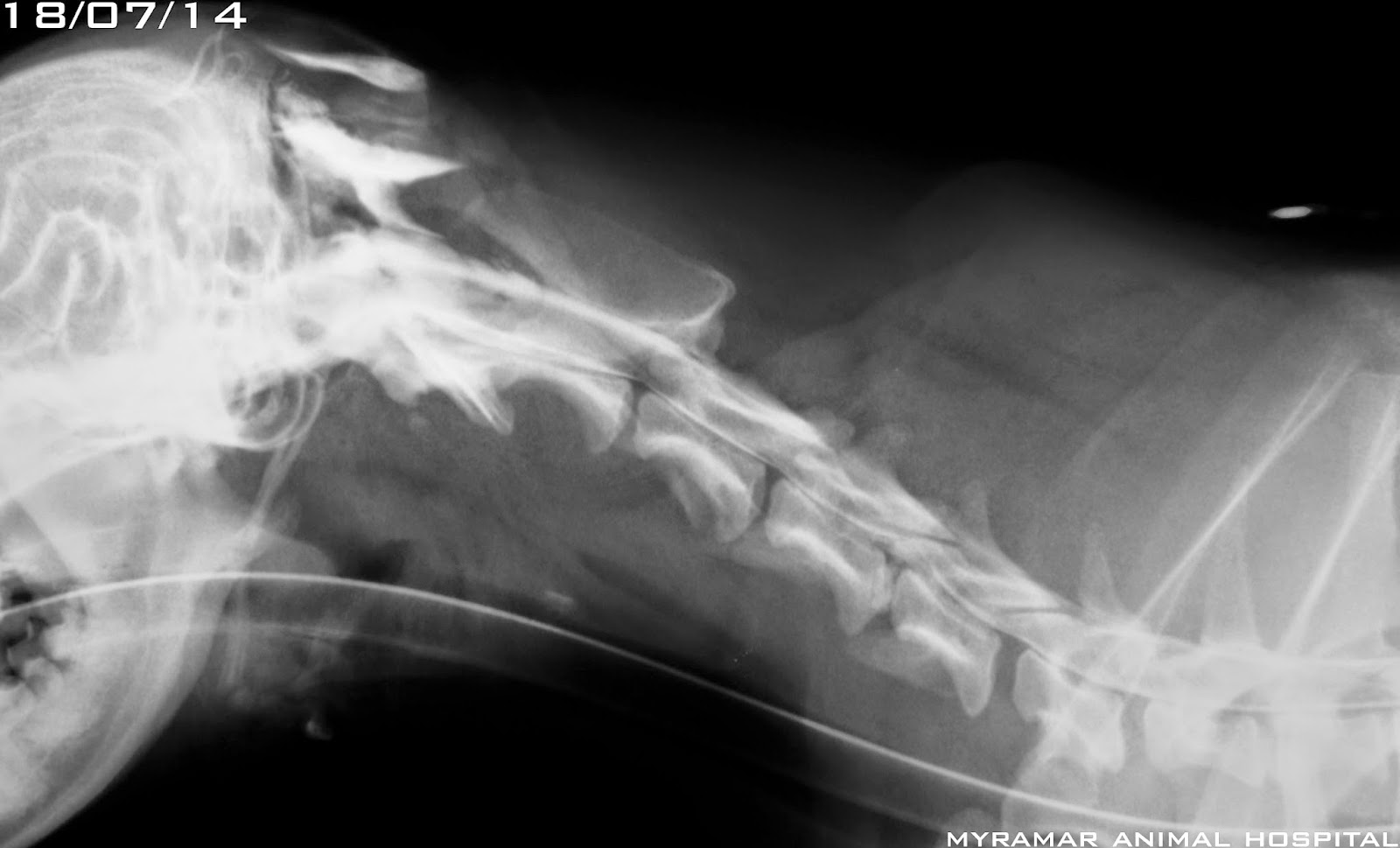 CIRUGÍA DE COLUMNA: ANTONIO. C4-C5. Slot cervical