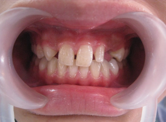 Tạo Má Lúm Đồng Tiền