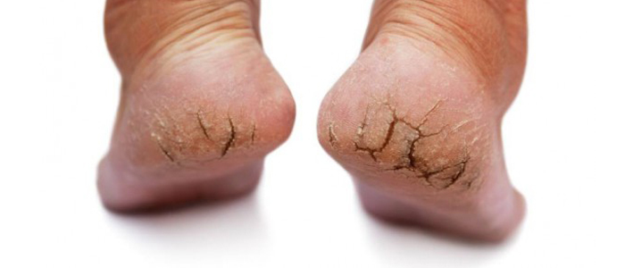 Pés e Calcanhares - Rachados e Ressecados Tratamento - Como Cuidar dos Pés