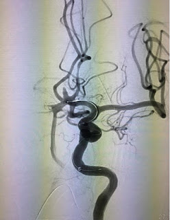 SAH with IVH, coiling and EVD done in same sitting in DSA | Science of ...