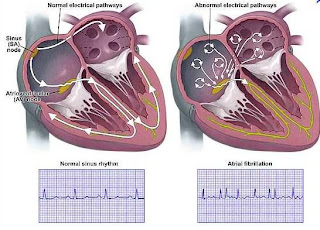 Human Diseases: Atrial Fibrillation / Flutter