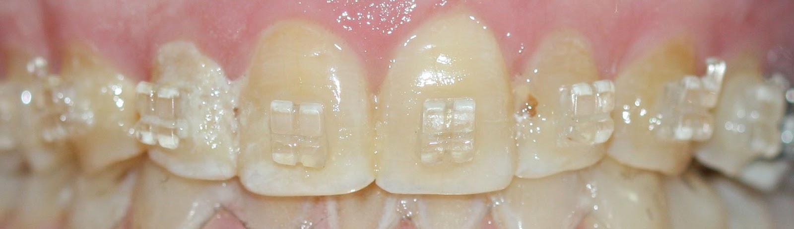James R. Waters, DDS, MSD, PA: Re-shaping and polishing edges of teeth ...