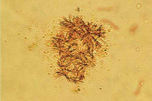 [Haematology] Microscopic Examination of Urinary Sediment - Crystals ...