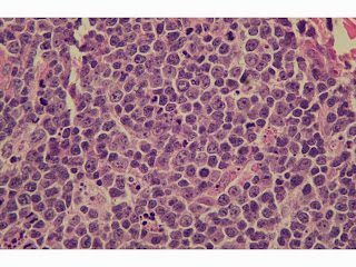 Dermpath Made Simple - Neoplastic: T and B cell lymphomas