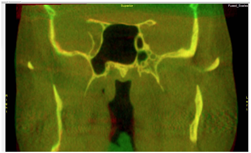 Facial Development Newsletter: Nasal and Oropharyngeal Airway ...