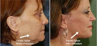 Medical Treatment Pictures-for Better Understanding: Superficial ...