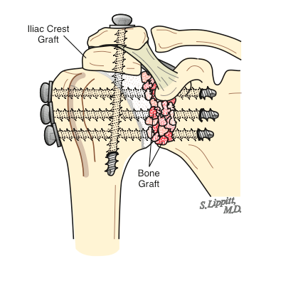 Shoulder Arthritis / Rotator Cuff Tears / Shoulder Pain : Shoulder ...