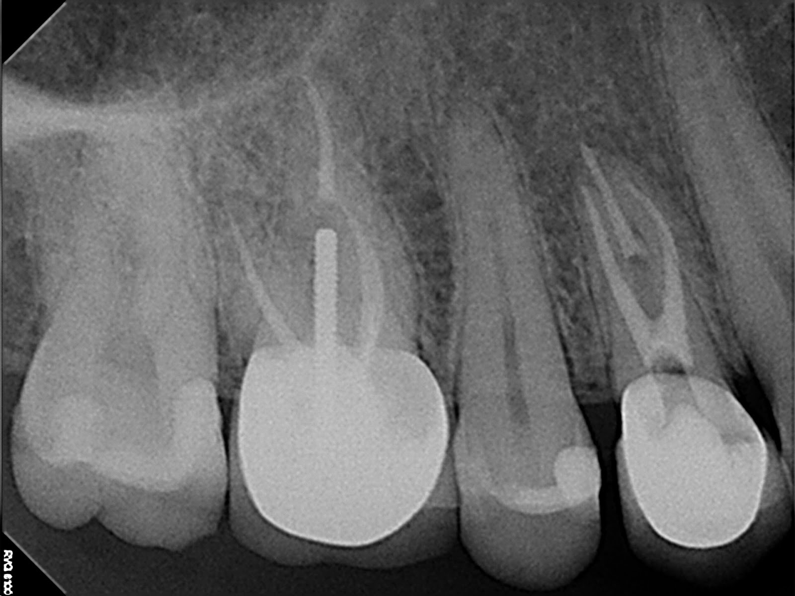 Bauman Endodontics: How many canals are normal in a pre-moalr?